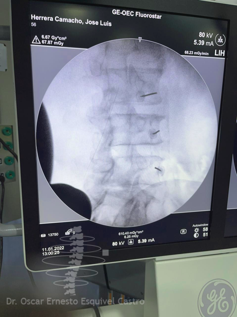 Simpatectomia lumbar – Especialistas del dolor